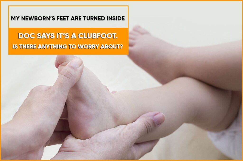 My newborn’s feet are turned inside. Doc says it’s a clubfoot. Is there ...