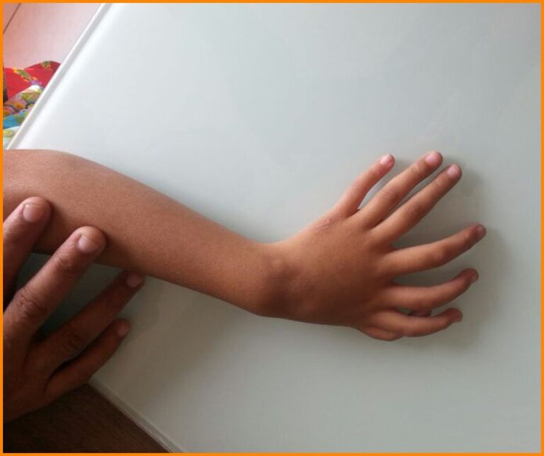 Polydactyly - Dr Rajeev Nirawane