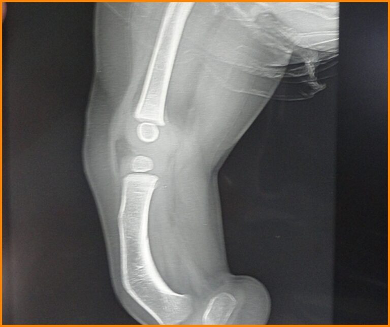 Fibular Hemimelia - Dr Rajeev Nirawane