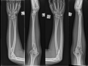What is radioulnar synostosis? - Dr Rajeev Nirawane