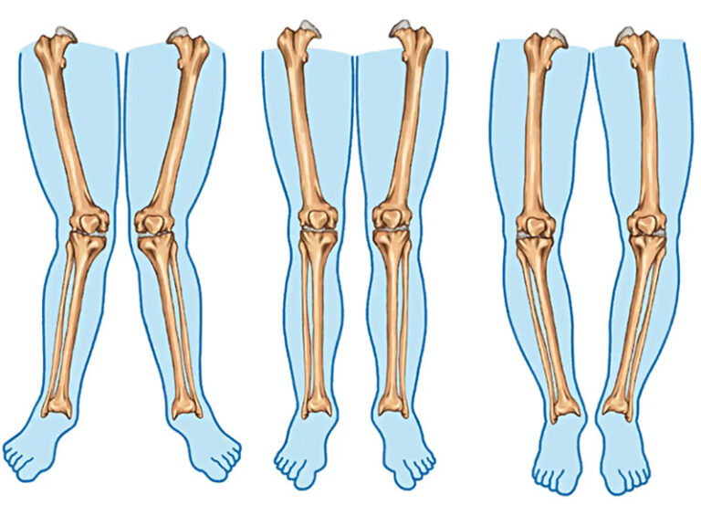 Understanding Various Aspects Of Bow Legs Treatment - Dr Rajeev Nirawane